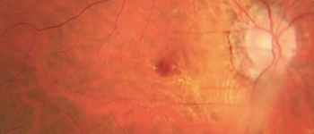 RetinaBase par Novartis